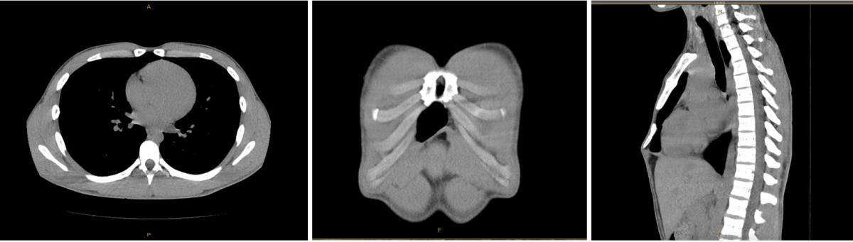 An Incidentally Found Sternal Foramen in a 16-Year-Old With Xiphodynia | CTSNet